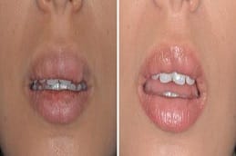 Lip Reduction Surgery in Riyadh & Saudi Arabia |Royal Clinic