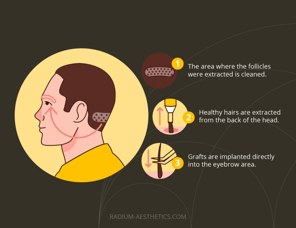 Eyebrow Hair Transplant in Riyadh, Jeddah & Saudi Arabia | Cost & Price